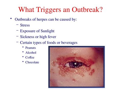 Common Sexually Transmitted Diseases Ppt Ppt