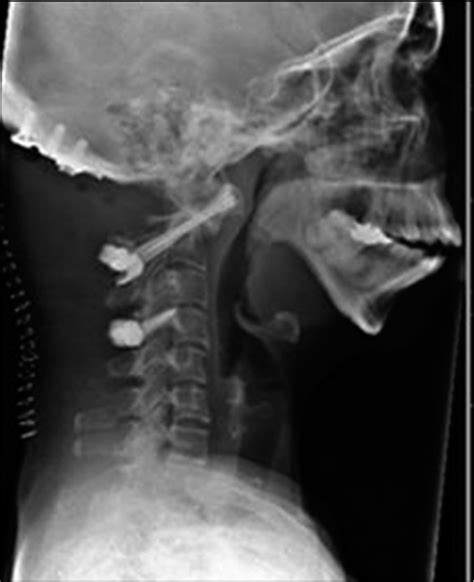 Surgical Neurology International