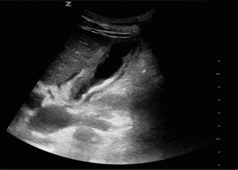 Acute Cholecystitis Anesthesia Key