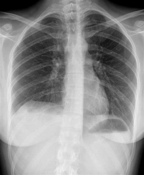 Pin On Thorax