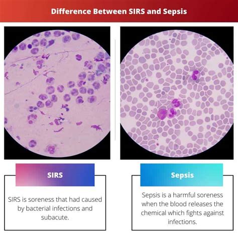 Sirs Vs Sepsis Perbedaan Dan Perbandingan