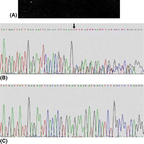 Mutation Detected By DGGE And Sequence Confirmation Of DelAinsTCT Download Scientific