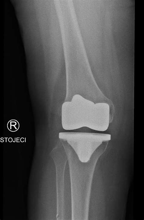 Boris Žulj On Linkedin How Not To Do Tka What Can I Say Everything Wrong Can Be Seen On