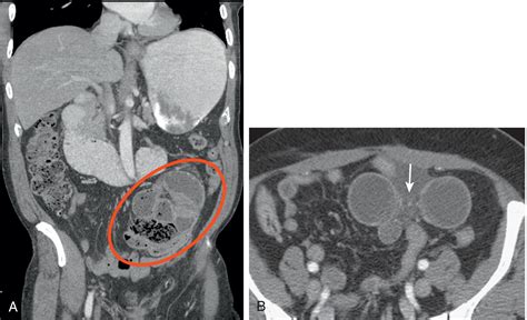 Hernias And Abdominal Wall Pathology Clinical Tree