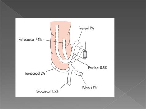 The Vermiform Appendix Dr Firas Majeed Ppt Download
