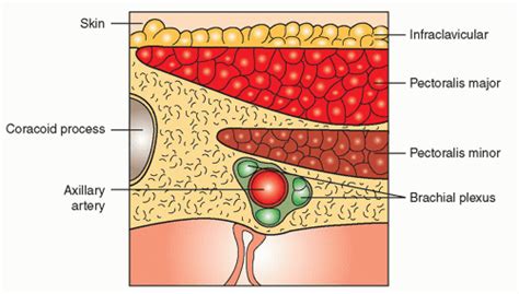 Ultrasound Guided Brachial Plexus Block Retroclavicular Approach Anesthesia Key