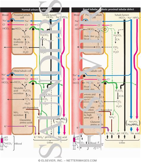 Renal Tubular Acidosis Ultrasound