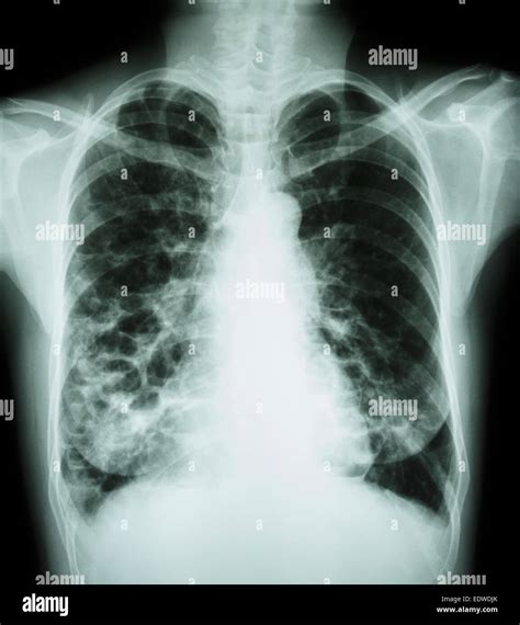 Chronic Bronchitis Chest X Ray