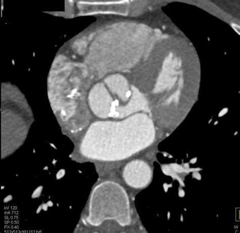 Aortic Valvular Calcification With Aortic Stenosis And Dilated Ascending Aorta Vascular