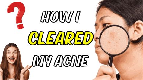 How I Cleared My Acne Youtube