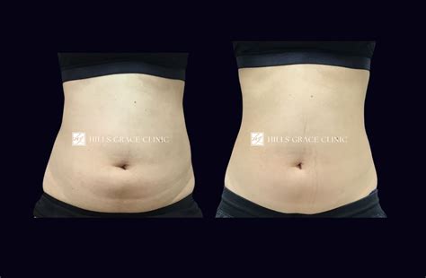 プロにまかせる、本気の痩身。 Hills Grace Clinic｜ヒルズグレイスクリニック