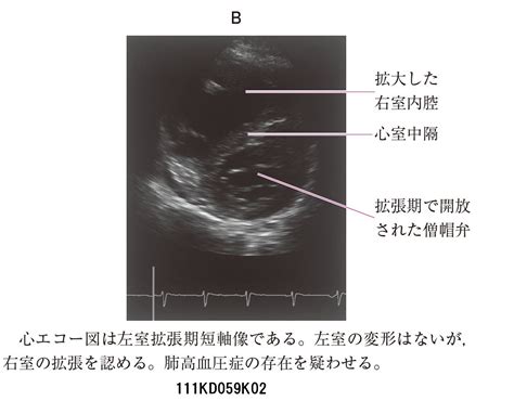 111d59 肺高血圧症 国試 テコプラ