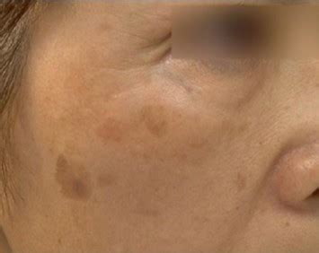 I2PL光治療ノーリス 那覇市の美容皮膚科 沖縄スキンケアクリニック
