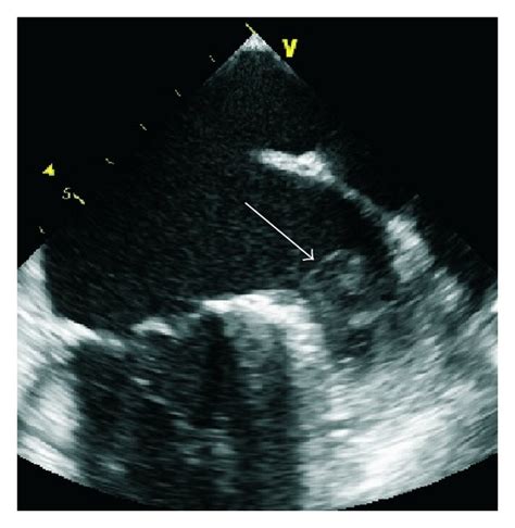 Thrombus Visualized In The Left Atrial Appendage Is Marked With An