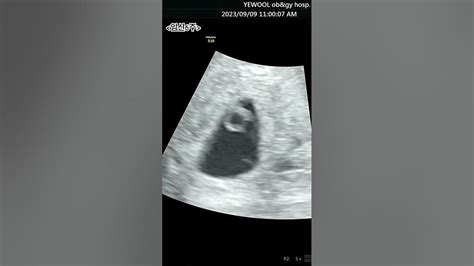 임신6주 첫 심장소리👶🏻 Youtube