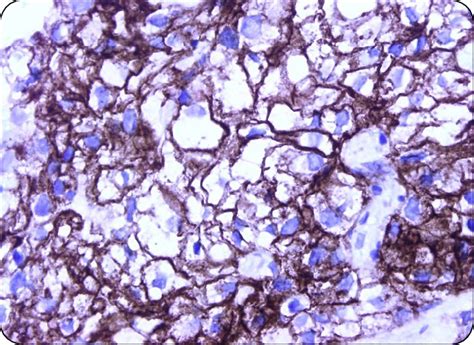 Metastatic Clear Cell Renal Cell Carcinoma Membranous Immunoreactivity