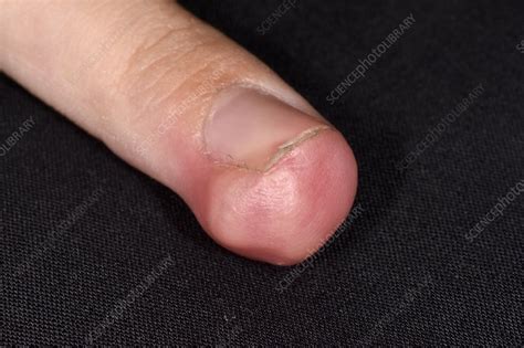 Glomus Tumor Toe