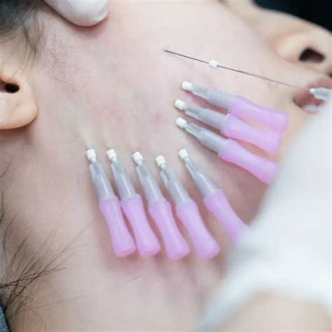 Fios De Pdo Dra Érika Freire Dermatologia E Tricologia