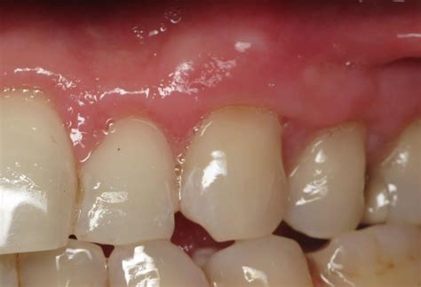 Thin Receding Gums And Dental Implants Whats Important Video By