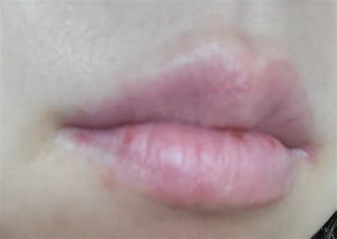 입술라인에 뾰루지 왜생길까요 지식in