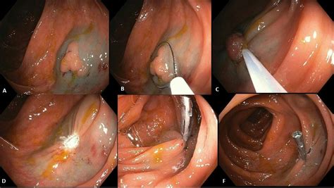 Endoscopic Resection Of Lst In Ascending Colon