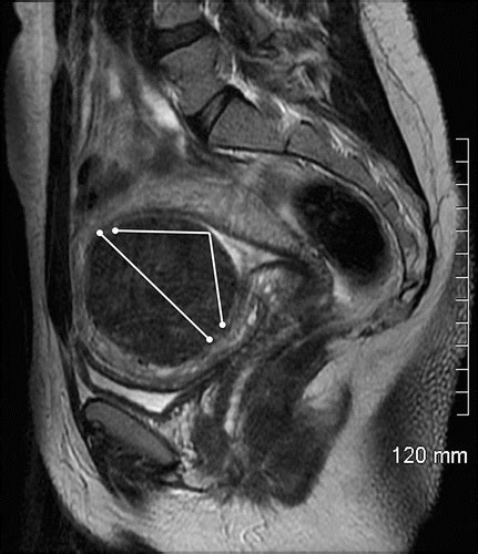 Uterine Fibroids Mri Scan Photograph By Zephyr