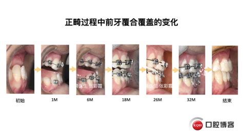 我的2022 成人骨性三类反颌正畸治疗 正畸医生 张彩霞的博客 Kq88口腔博客