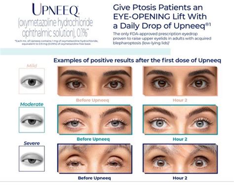 Eye Drops For Eye Pressure Side Effects At Rickey White Blog