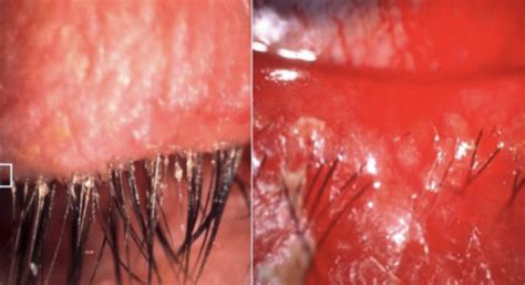 Cl Complications Blepharitis And Mgd Flashcards Quizlet