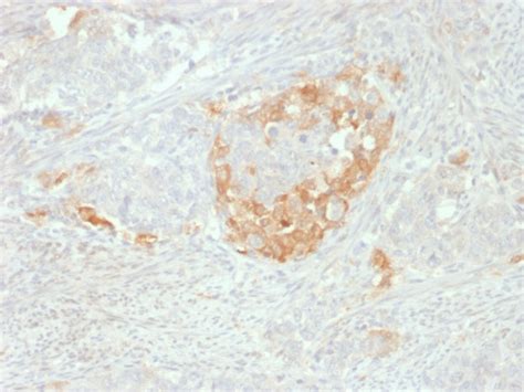 Nse Gamma Neuron Specific Enolase Gamma Neuroendocrine Marker