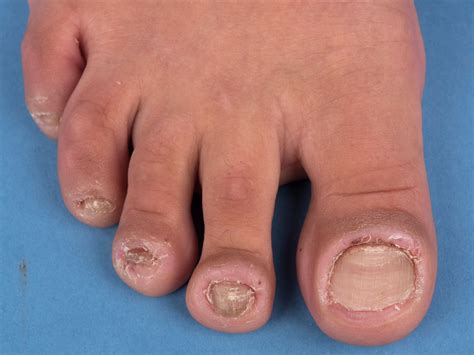 Paronychia éadrom 2024 New 4box80pcs German Toenailheal Relief Patch