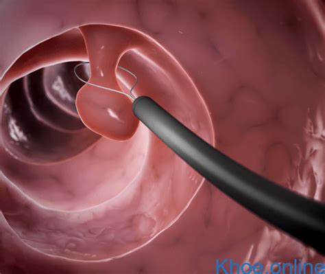 Polyp C T Cung Nguy N Nh N Tri U Ch Ng I U Tr Kh E Online