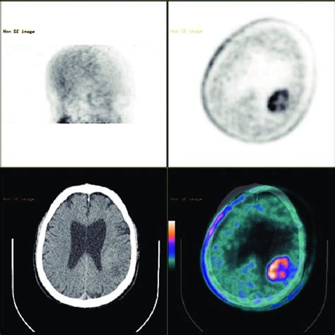 Brain Perfusion Spect Imaging With 99mtc Hmpao In A Patient With