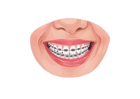 Braces Cost From 1100 Up To 13000