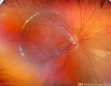 Vipin Kumar On Linkedin Optomap Of 13 Year Old Female With Hemangioma