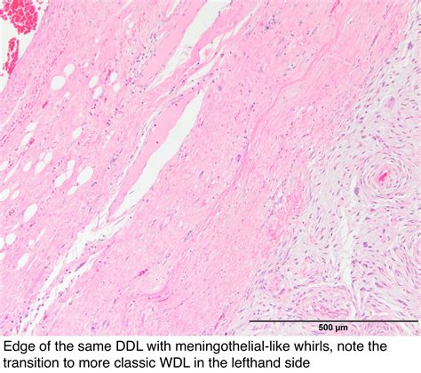 Dedifferentiated Liposarcoma Pathology