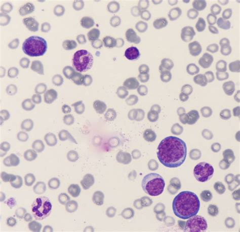 Eritroblastos Circulantes