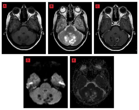 A T1w Axial B T2w Axial C T1w Post Contrast Axial D Diffusion