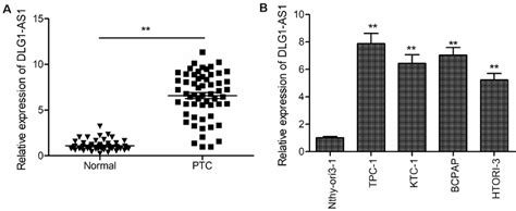 DLG1 AS1 Expression Is Upregulated In PTC Tissues And Cell Lines A