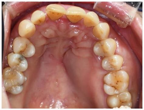 Applied Sciences Free Full Text Tumor Induced Osteomalacia As A