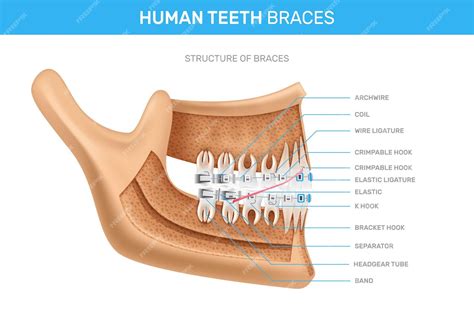 Free Vector Human Teeth Braces Realistic Infographics