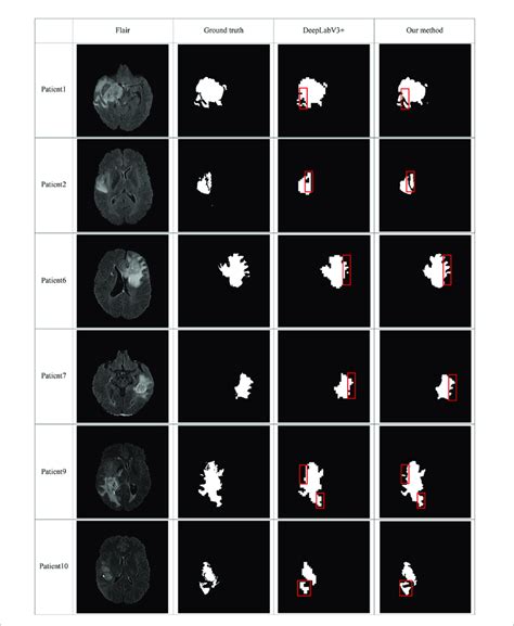 Comparison Of Brain Tumor Segmentation Results Between Our Method And