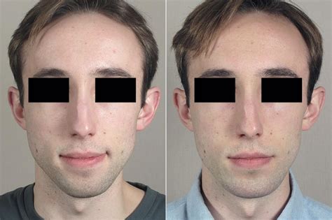 Chin Implant Before And After Pictures Case 256 Paramus New Jersey