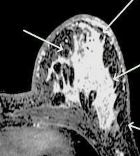 Personalised Breast Cancer Risk Assessment Is Here Gp Voice