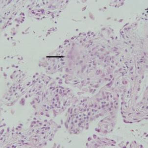 Histological Examination Of Transbronchial Biopsyrevealedmild To