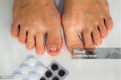 부상된 발톱과 알 약 건강관리와 의술에 대한 스톡 사진 및 기타 이미지 건강관리와 의술 균류 발 Istock