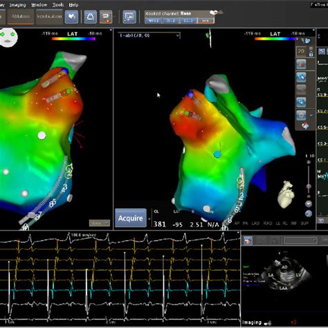 The Activation Map Shows That Left Atrial Appendage Is The Origin Of