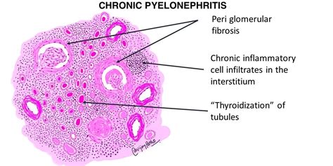 Pathology Outlines Chronic Pyelonephritis