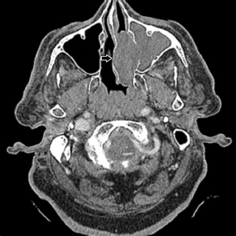 Ct Axial View Of The Paranasal Sinuses Showing Nonenhancing Soft