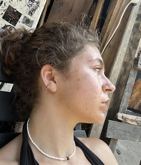 Three Months On Differin R Acne